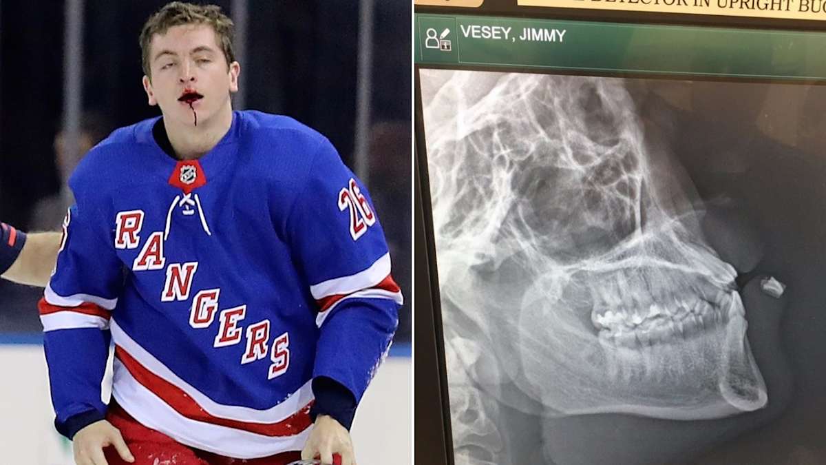 hockey players with the worst teeth