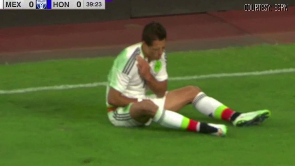 broken bones in soccer