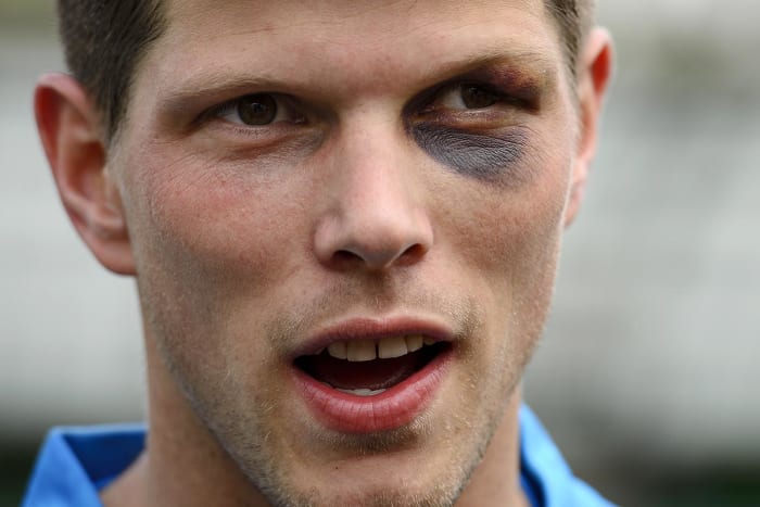 Black Eyes in Sports - Sports Illustrated