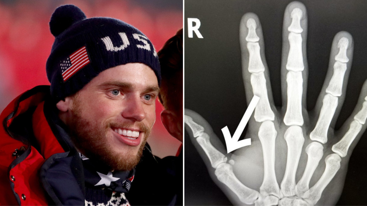 Gus Kenworthy injury: Skier breaks thumb, jokes about Mike Pence ...