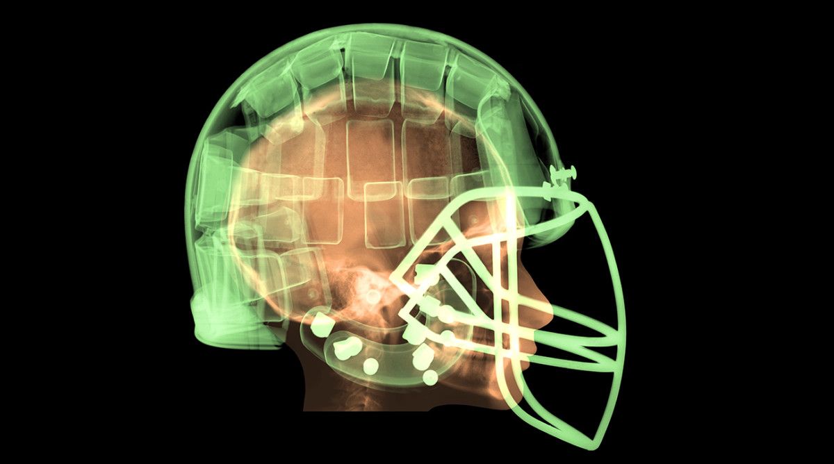 CTE Diagnosis in Living NFL Football Players - Sports Illustrated