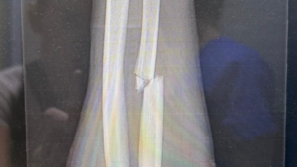 Photo: UFC 299 Main Card Winner Suffered Broken Limb 'Early' in Fight ...